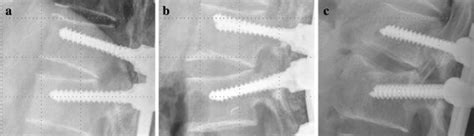 Three Anterior Opening Level A Disc Level B Lower Endplate Of Upper