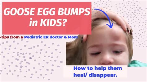How To Treat Goose Egg Bumps Pediatrician Explains Youtube