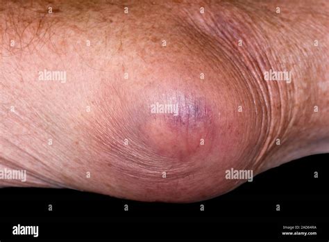 Bursitis Of The Elbow Close Up Of The Inflamed Elbow Olecranon Of A 81 Year Old Male Patient