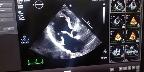 Amardyuti Bhowmik On Linkedin 56 Year Old Male Having Af Severe Mr