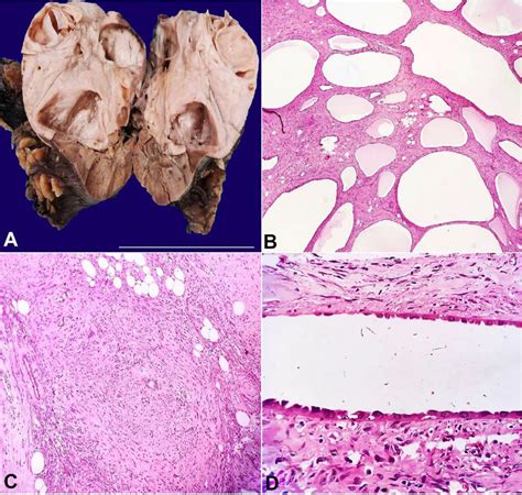 A Gross View Of The Surgical Specimen Showing Large Solid Grey White