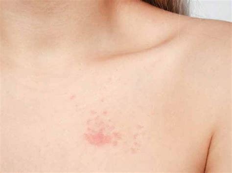 Why Skin Rashes And Hives Occur During Menstruation Rashes During