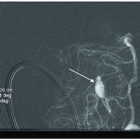 Computer Tomography Angiography With Aneurysm Of The Left Sca