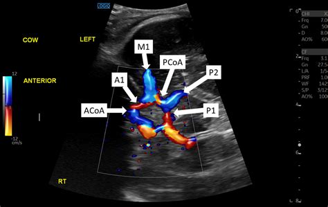 Pre‐operative Transcranial Doppler Ultrasound Assessment Of Cerebral