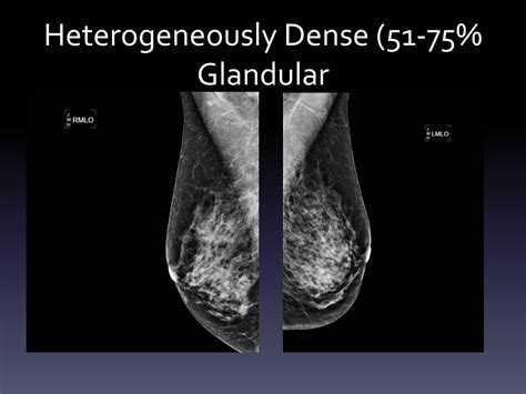 Ppt Breast Cancer Screening Whats New To Know The Issue Of Breast Density Powerpoint