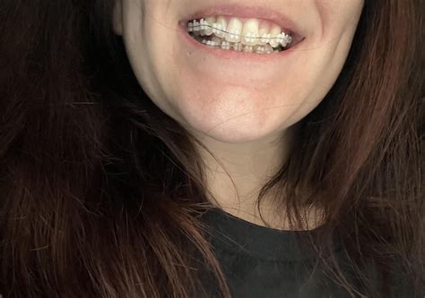 Lightforce 3d Printed Braces Rbraces