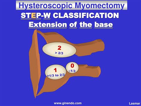 Ppt Hysteroscopic Myomectomy Powerpoint Presentation Free Download Id 1302228