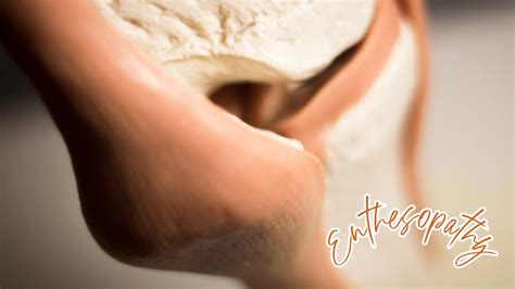 How To Treat Enthesopathy Anf Academy