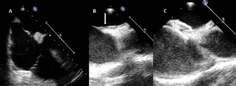 Tee Before And After Pfo Closure In Patient 1 A Pfo In The Download Scientific Diagram