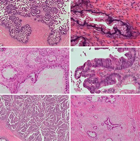 Glandular Pattern Meaning At Susan Smtih Blog