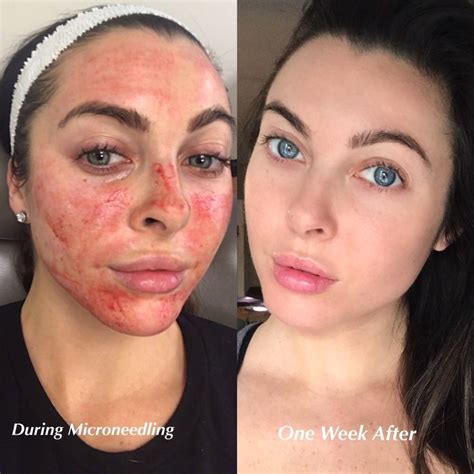 Facial Care After Microneedling At Gerald Chambers Blog