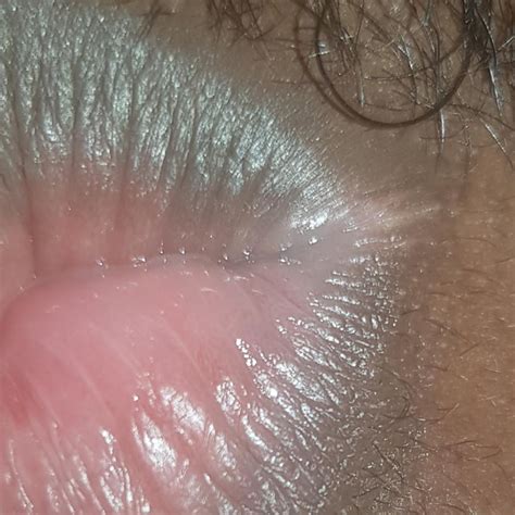 Angular Cheilitis Scarhypopigmentation Any Fix Rblackskincare