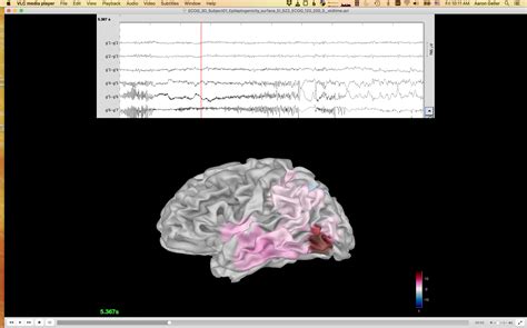 Epileptogenicity Tutorial Movie Time All Figures Cuts Off Figure