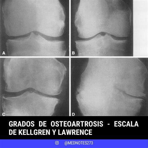 Grados De Osteoartrosis ReumatologÍa Medandciencia Udocz