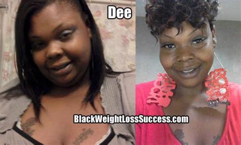 Dee Lost 156 Pounds With Weight Loss Surgery Black Weight Loss Success