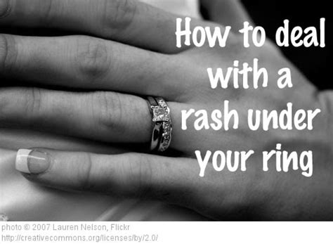 Wedding Ring Finger Rash