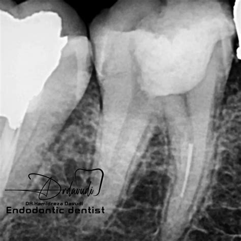 ‎دکتر سید حمید رضا داودی‎ ‎درمان ریشه مولر اول مندیبل و پر کردن کلیه کانال ها با Mta شاید