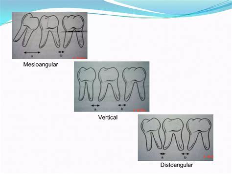 Mandibular 3rd Molar Impactions Pptx