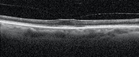 Types Of Posterior Vitreous Detachment