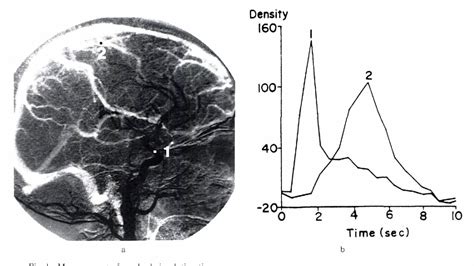 Figure 1 From Comparison Of Mean Flow Velocity By Tcd With Cerebral