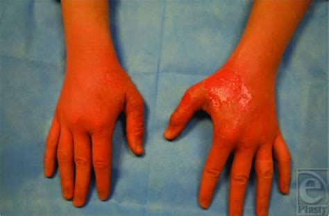 Phytophotodermatitis Pmc