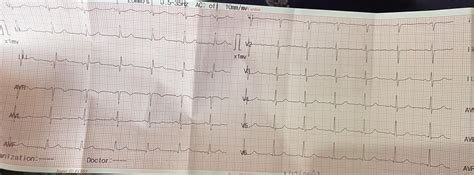 Inferior Or Nstemi Rekgs