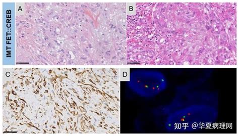 分子时代学病理 非脑膜上皮性中枢神经系统肿瘤新进展（一） 知乎