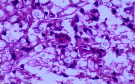 General Pathology Infection