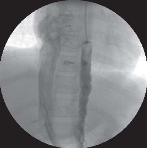 Hemiazygos Vein Catheter Showing Contrast Of Its Drainage To Inferior