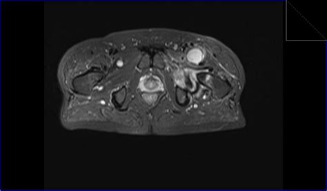 Iliopsoas Bursitis Mri Iliopectineal Bursitis Radiology Article
