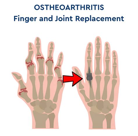 Hand And Finger Joint Replacements Dr Oscar Brumby Rendell