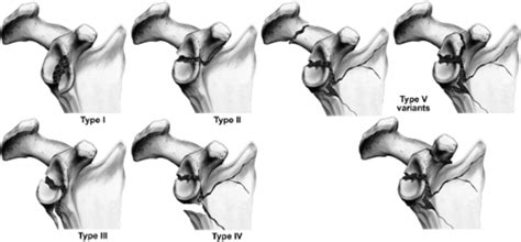 Scapula Fractures Open Reduction Internal Fixation Musculoskeletal Key