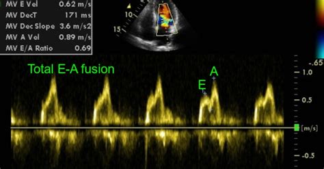 Transmitral Doppler Tracing From Apical Four Chamber View Showing