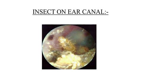Tympanic Membrane Pptx