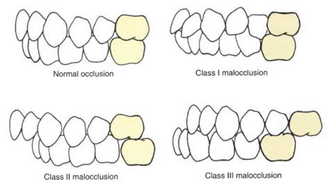 Class 3 Malocclusion Causes Signs And Treatment Atlas Dental