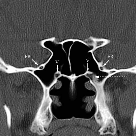 Pneumatization Of The Anterior Clinoid Processes Encroaching Both Optic Download Scientific
