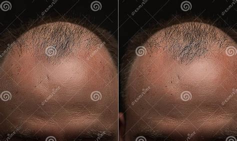 Transformation Of Hair Density Through Innovative Treatment Showcased