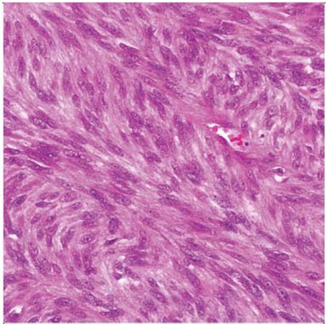 Adult Type Fibrosarcoma Basicmedical Key