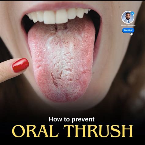 Did You Know A Common Fungus Can Cause White Patches In Your Mouth