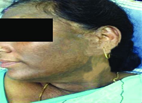 Lichen Planus Pigmentosus Download Scientific Diagram