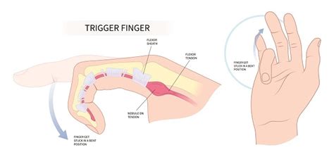 Trigger Finger Gejala Penyebab Dan Pengobatan Alodokter