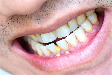Can Tooth Calcification Be Reversed A Comprehensive Guide