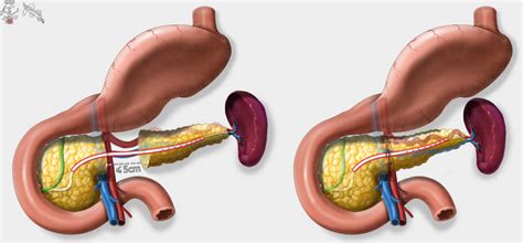 An end-to-end pancreatic anastomosis in robotic central pancreatectomy | World Journal of ...