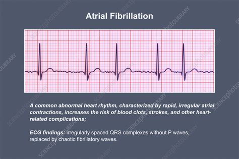 Ecg In Atrial Fibrillation Illustration Stock Image F042 5163 Science Photo Library