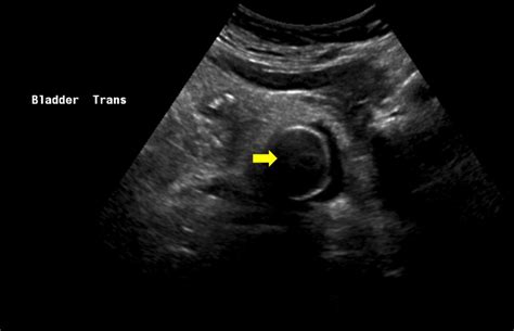 Abnormal Bladder Ultrasound