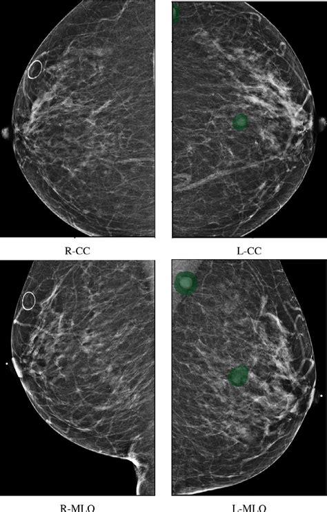 Example Screening Mammography Exam Each Exam Is Associated With Four