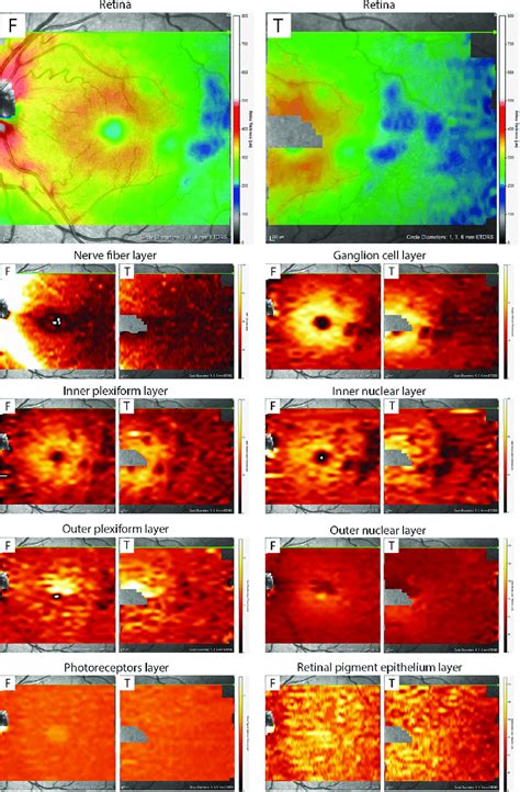 Example Of Individual Retinal Layer Thickness Measurement In Subject