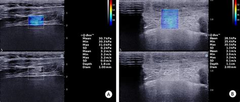 2d Swe Measurement Of The Elastic Modulus Of Respiratory Muscle In