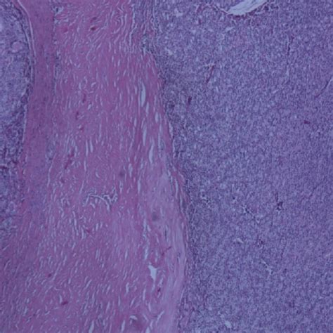 Follicular Carcinoma Of Thyroid Capsular Involvement Download