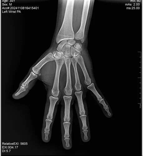 Wired Digital Radiography System Scintillation Detectors At ₹ 600000